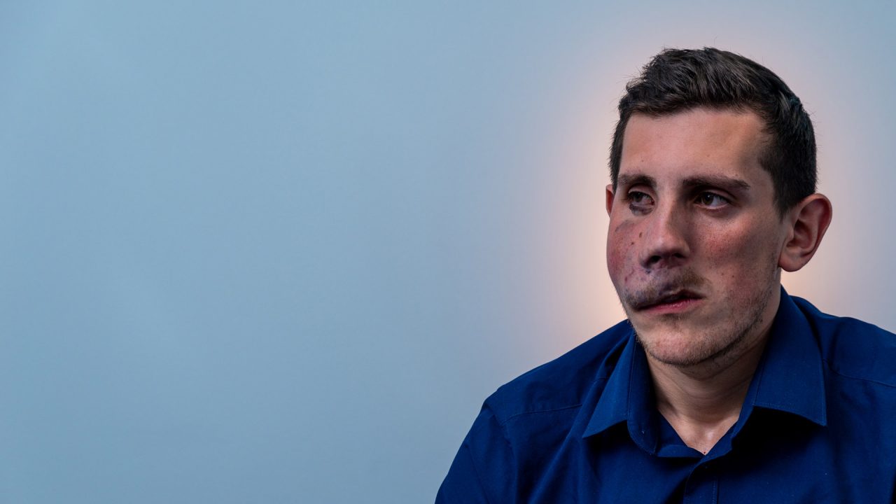 Types Of Visible Difference & Disfigurement | Changing Faces