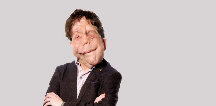 Types Of Visible Difference & Disfigurement | Changing Faces