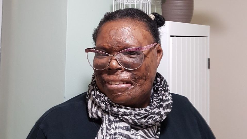 Our Campaigners | Visible Difference Charity | Changing Faces