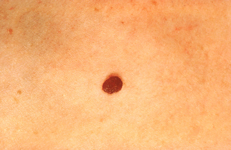 What Is A Birthmark? | Conditions | Changing Faces