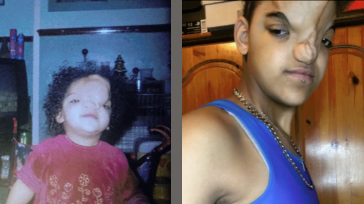 Tee’s Story - Being Trans & Confidence With Visible Difference