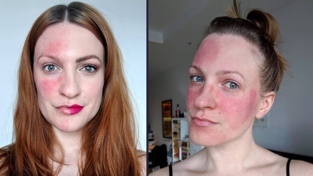 Lex’s story: Rosacea has made me a better person - Changing Faces