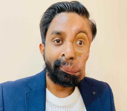 Changing Faces | Visible Difference & Disfigurement Charity