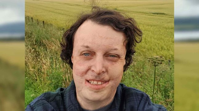 Real Stories By People With Disfigurements | Changing Faces