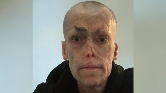 Real Stories By People With Disfigurements | Changing Faces