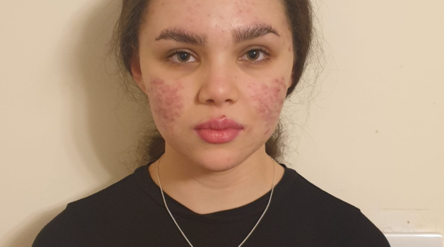 Real Stories By People With Disfigurements | Changing Faces