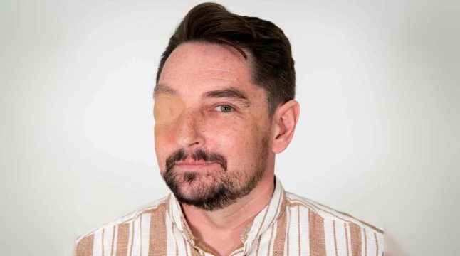 Real Stories By People With Disfigurements | Changing Faces