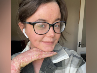 Real Stories By People With Disfigurements | Changing Faces