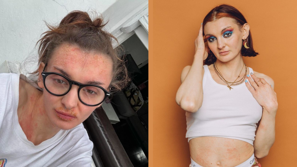 Anthony Lexa: “Beauty isn’t skin deep.” - Changing Faces