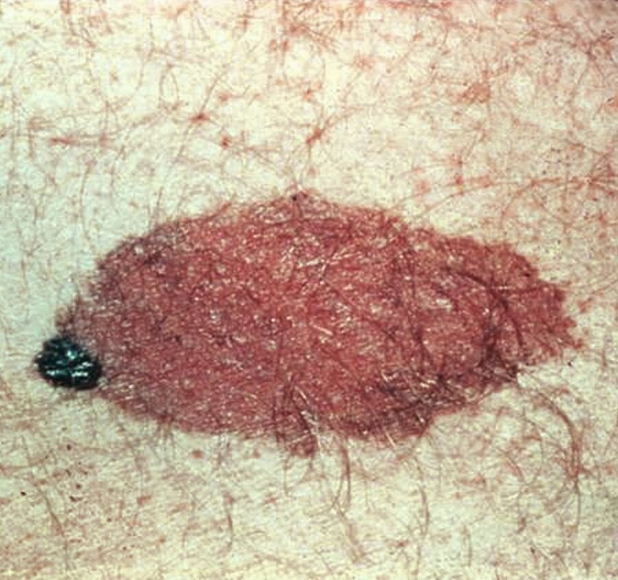 Congenital Melanocytic Naevi | Conditions | Changing Faces